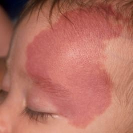 Port Wine Stains - Patient Resources - Pediatric Dermatology of North Texas
